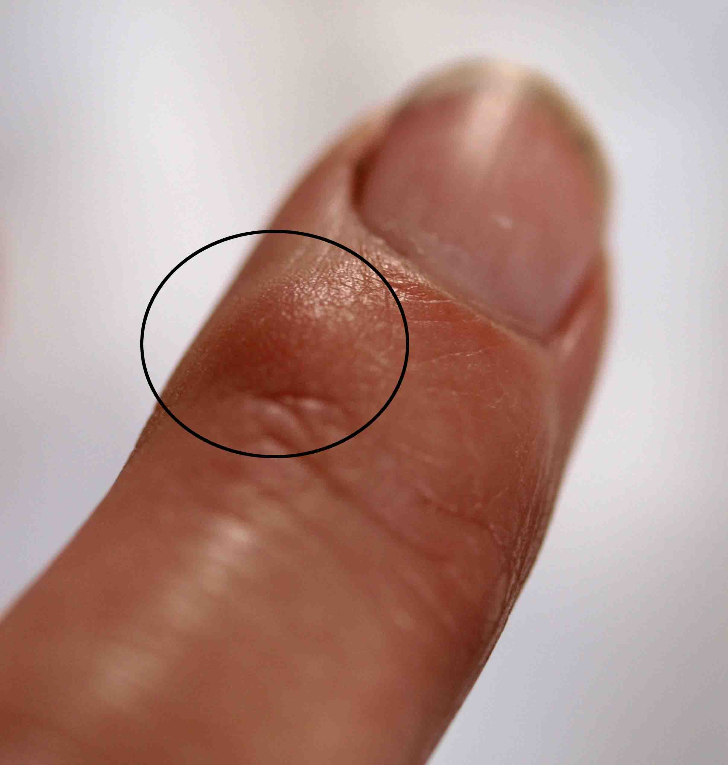 Writers’ Bumps: An Endangered Condition? by Marie Zhuikov – Lake ...